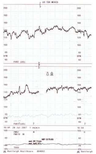 Sonicaid BD4000xs - CTG monitor | Katalog izdelkov | MEDICOtehna